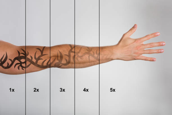 The Healing Process What To Expect After Tattoo Removal In NYC