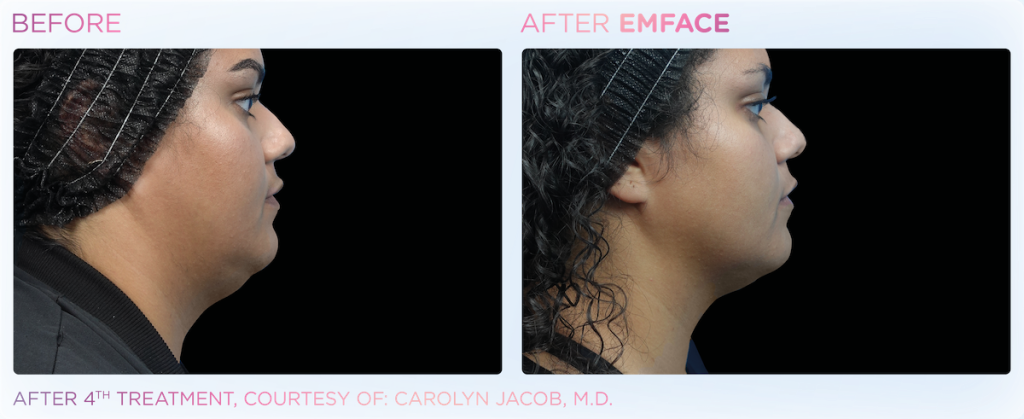 EMFACE NYC — Non-Invasive Facial Rejuvenation | Dr Akhavan