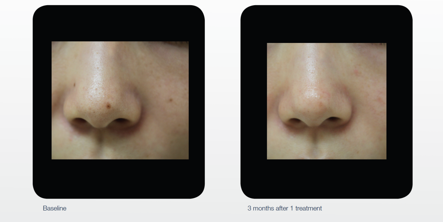 Best Cosmetic Mole Removal in NYC - Expert Physician