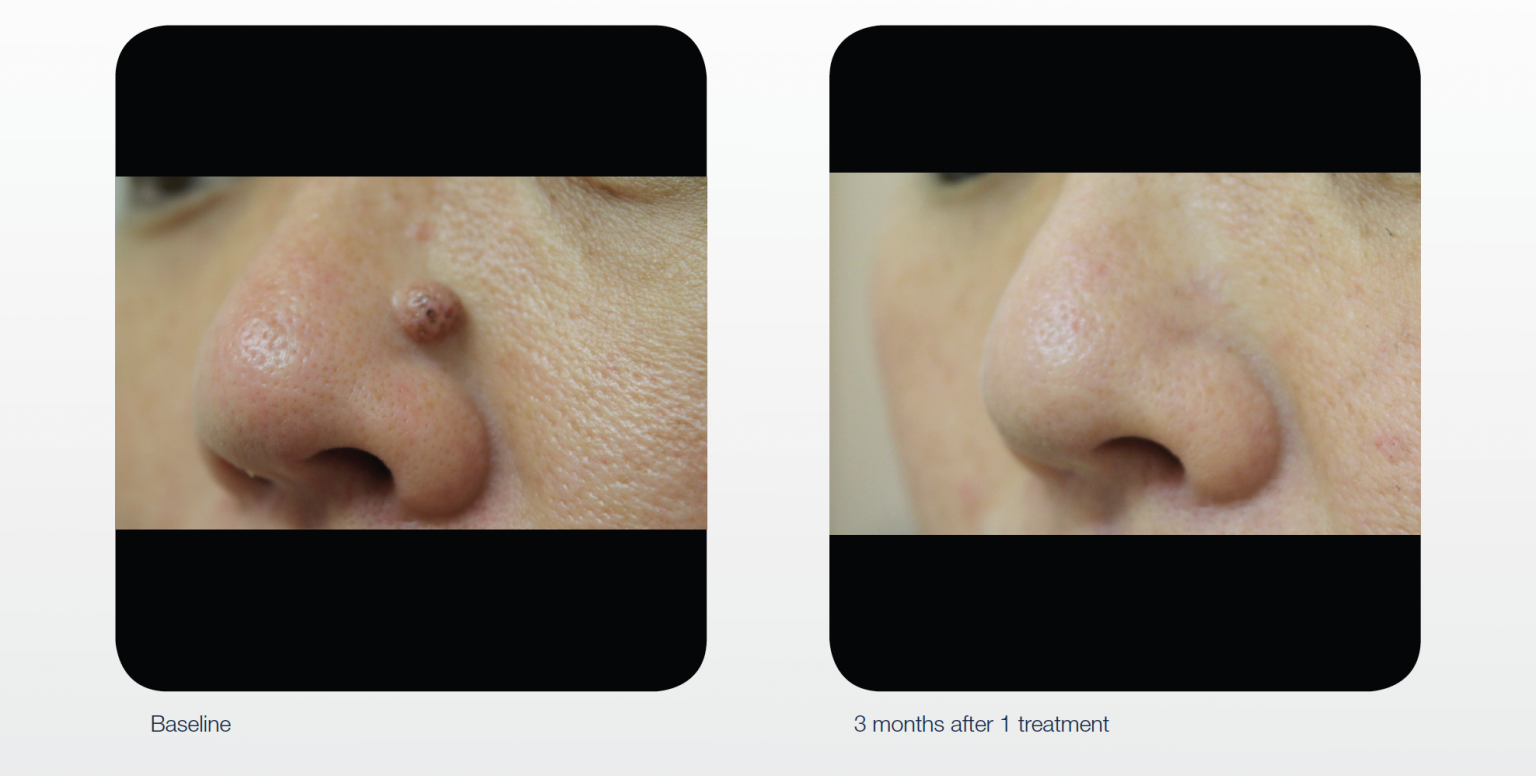 Best Cosmetic Mole Removal in NYC - Expert Physician
