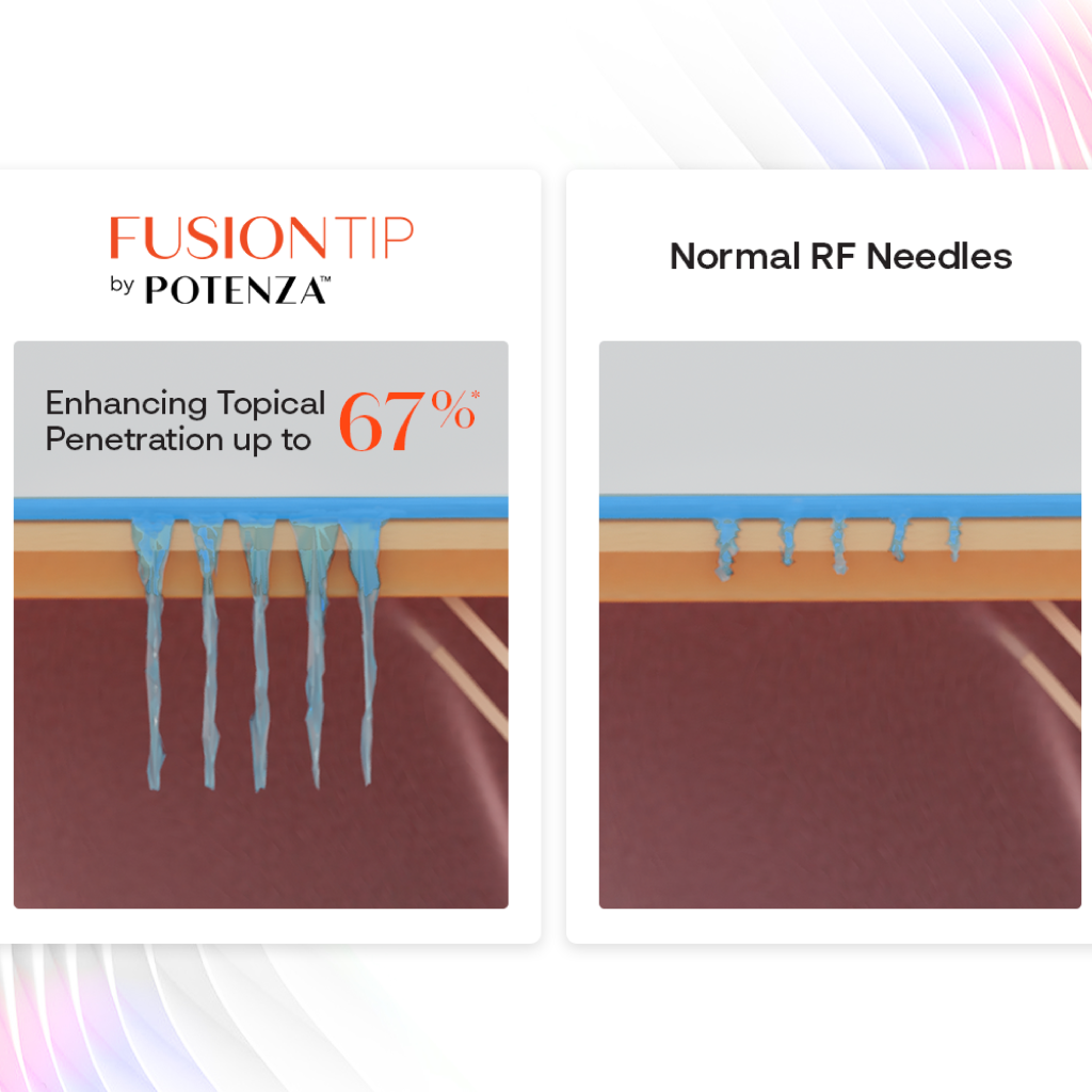 Potenza RF Microneedling NYC | Gentle Fusion™ Face & Body